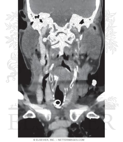 CT Coronal Reconstruction Through the Laryngeal Mass CT Coronal Reconstruction Through the Laryngeal Mass