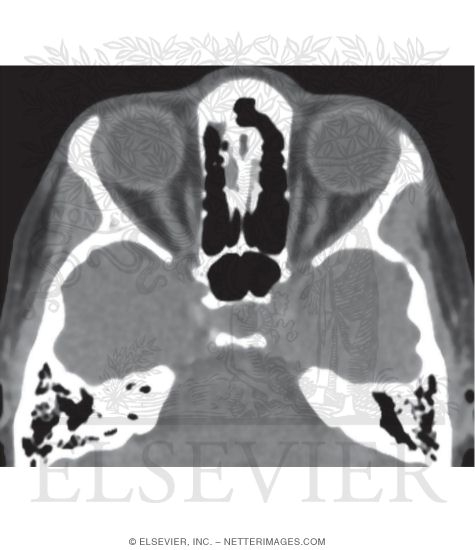 Axial CT Through the Ethmoid and Splenoid Sinuses and Orbits