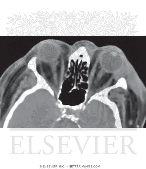 Axial CT With a Soft Tissue Window Following the Injection of Contrast