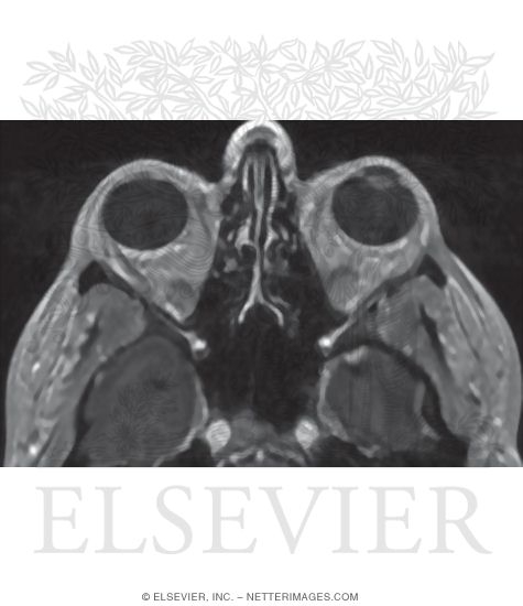 Axial T1 MRI After Contrast Through the Orbit and Posterior Aspect of ...