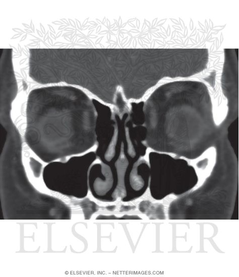 Coronal CT Reconstruction With a Soft Tissue Window Through the Orbit ...