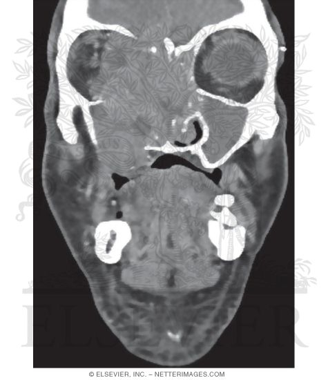 Coronal CT Reconstruction With a Soft Tissue Window Showing a Large ...