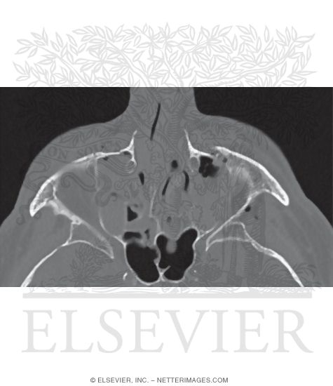 Axial CT of the Sinus and Orbit