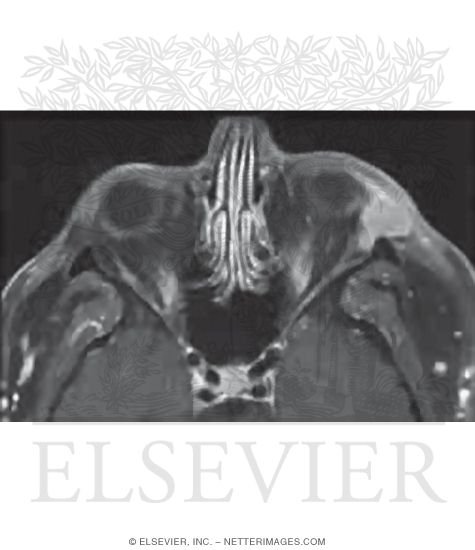 Axial T1 MRI of the Sinus and Orbit