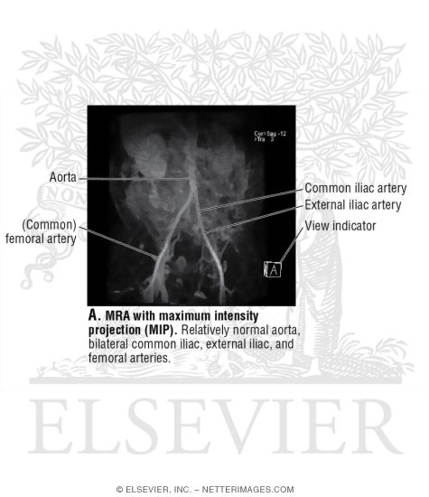 MRA With Maximum Intensity Projection (MIP)