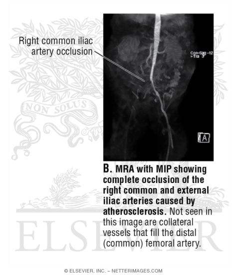 MRA With Maximum Intensity Projection (MIP) Showing Complete Occlusion ...
