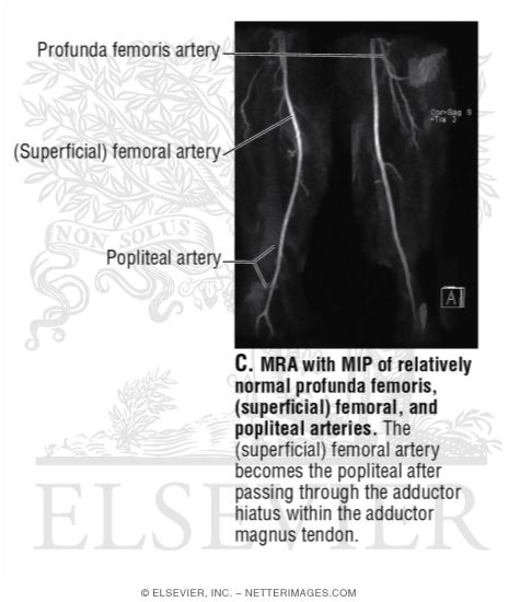 MRA With Maximum Intensity Projection (MIP) of Relatively Normal ...