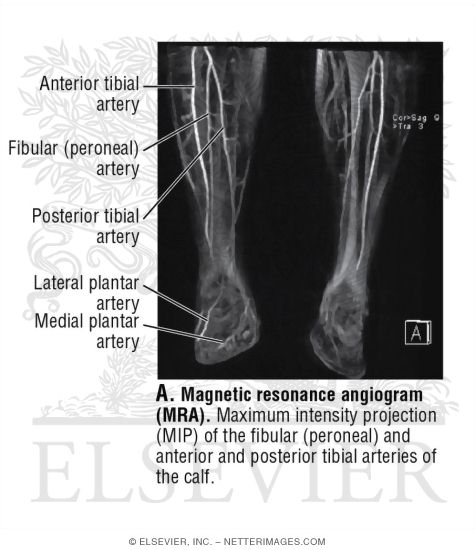 Watermarked preview of unlabeled image: Magnetic Resonance Angiogram (MRA)