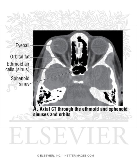 ethmoid sinus ct