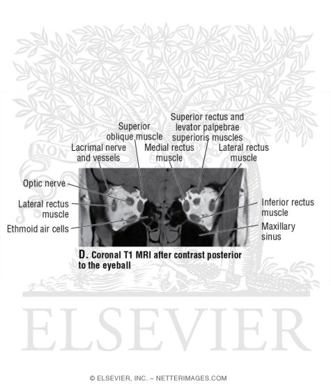 Coronal T1 MRI After Contrast Posterior to the Eyeball
