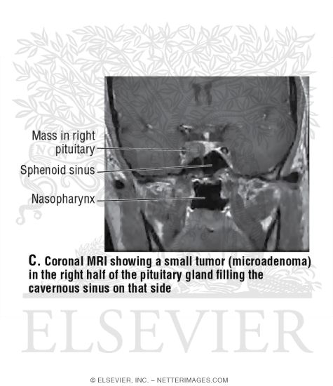 Coronal MRI Showing a Small Tumor (Microadenoma) In the Right Half of the Pituitary Gland