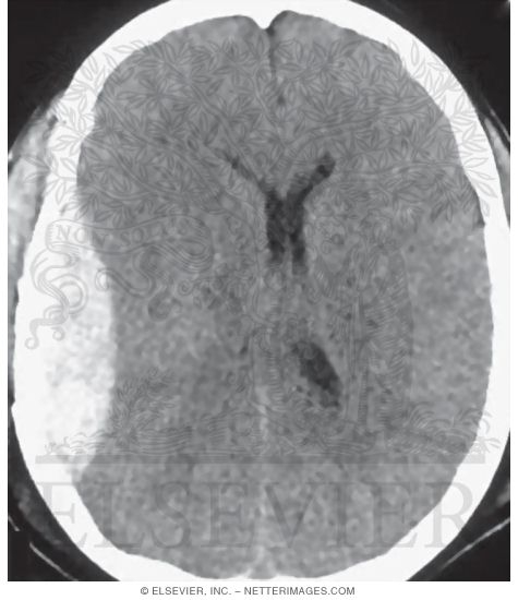 Axial CT With a Soft Tissue (Brain) Window
