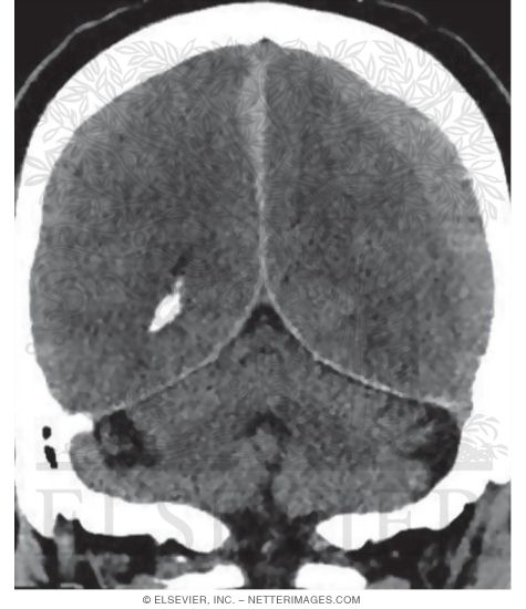 Coronal CT Reconstruction Showing an Acute Subdural Hematoma Coronal CT Reconstruction Showing an Acute Subdural Hematoma