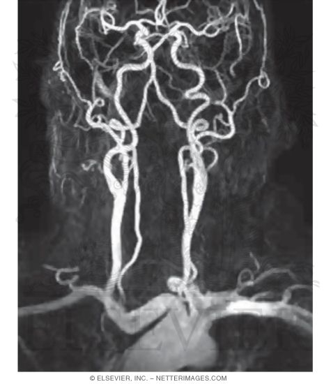 Angiogram of Circulation to the Head and Neck