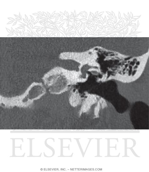 Coronal CT Reconstruction of the Left Temporal Bone