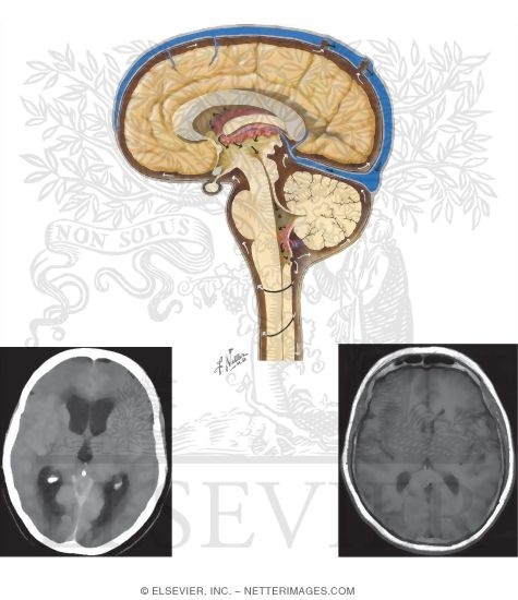 Circulation of Cerebrospinal Fluid and Hydrocephalus