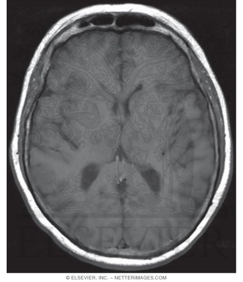 T1 MRI of a Patient With Ventricles of Normal Size