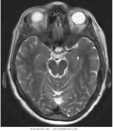 T2 Axial Mri Through The Upper Cerebellum