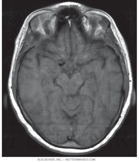 T1 Axial MRI Through the Optic Chiasm