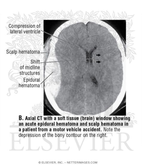 Axial Ct With A Soft Tissue Brain Window