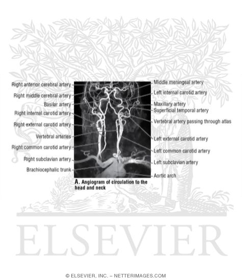 Angiogram of Circulation to the Head and Neck