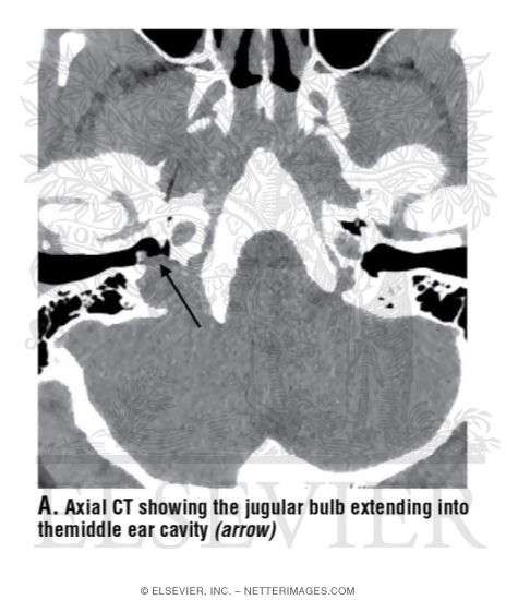 Axial CT Showing the Jugular Bulb Extending Into the Middle Ear Cavity