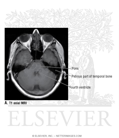 T1 Axial MRI Through the Cerebellum, Temporal Lobes, and Eye
