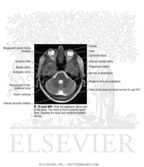 T2 Axial MRI Through the Cerebellum, Temporal Lobes, and Eye