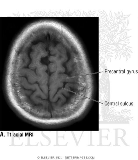 T1 Axial MRI Through the Thalamus and Lateral Ventricles