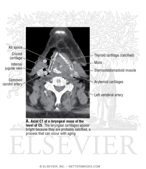Axial CT of a Laryngeal Mass at the Level of C5