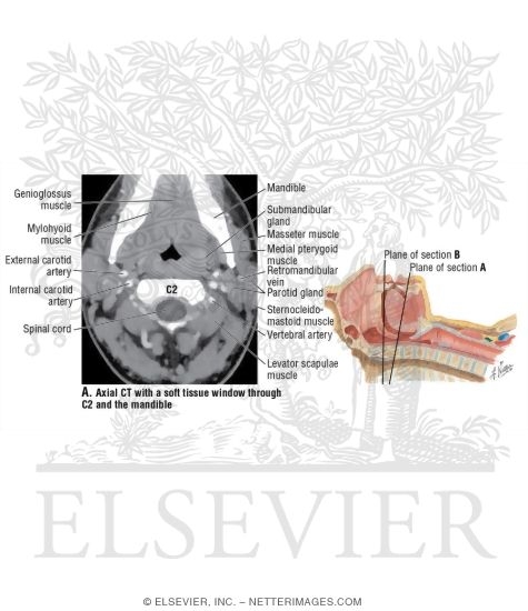Axial CT With a Soft Tissue Window Through C2 and the Mandible