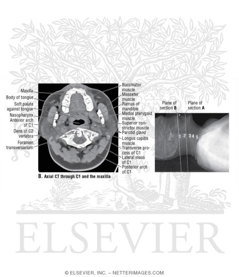 Axial CT Through C1 and the Maxilla