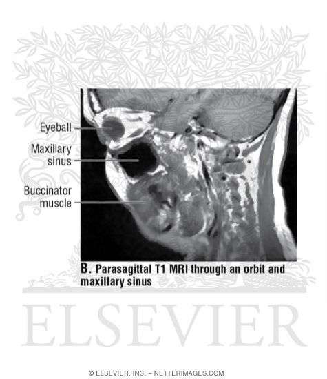Parasagittal T1 MRI Through an Orbit and Maxillary Sinus