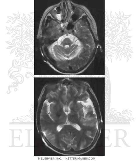 Diagnosis of Multiple System Atrophy