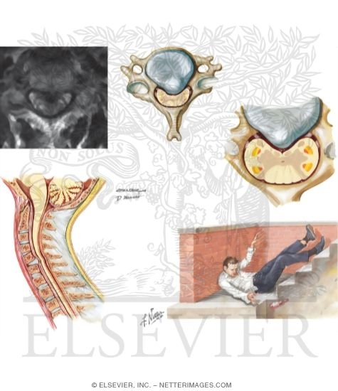 Cervical Disc Herniation