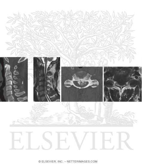 Imaging of Ossification of Posterior Longitudinal Ligament (OPLL)