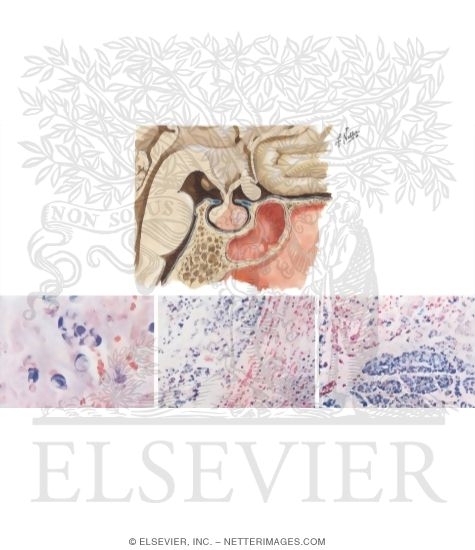 Basophilic Adenoma Cushing Disease