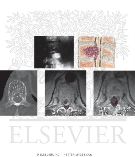 Extradural Primary Benign Spinal Tumors
