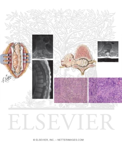 Intradural Extramedullary Primary Spinal Tumors