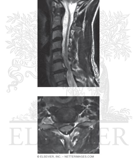 Large Right Lateral C6-C7 Disc Herniation