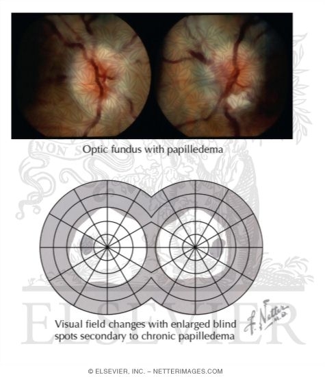 Effects of Increased Intracranial Pressure On Optic Disk and Visual Fields