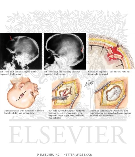 Compound Skull Fracture