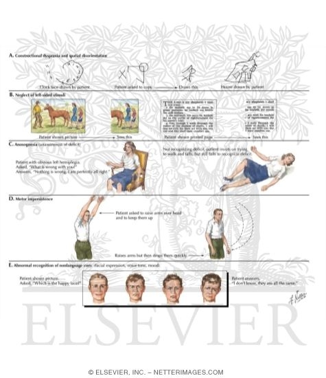 Nondominant Hemisphere Higher Cortical Dysfunction