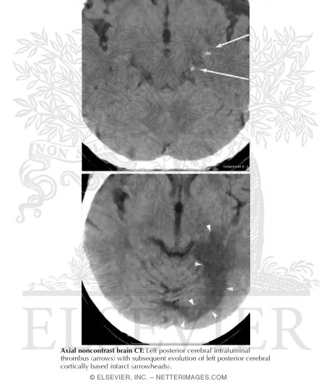 Axial Noncontrast Brain CT