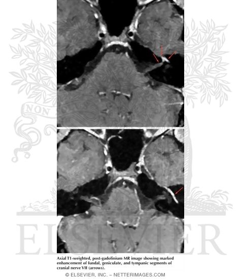 Imaging of Bell Palsy