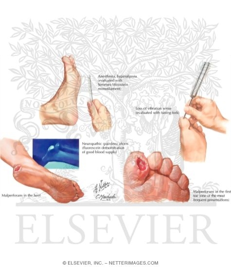 Diabetes Mellitus and Neuropathy