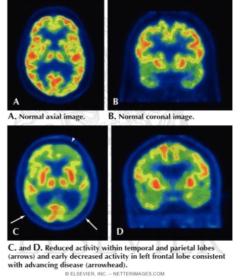 FDG-PET Typical Pattern for Alzheimer Disease