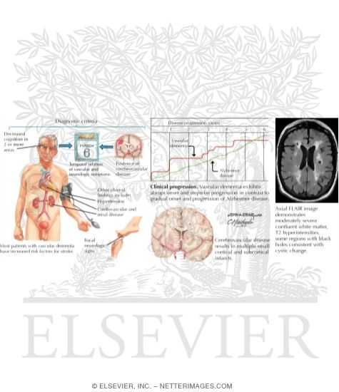 Vascular (Multi-infarct) Dementia