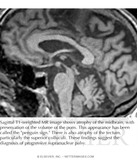 Magnetic Resonance Imaging In Progressive Supranuclear Palsy