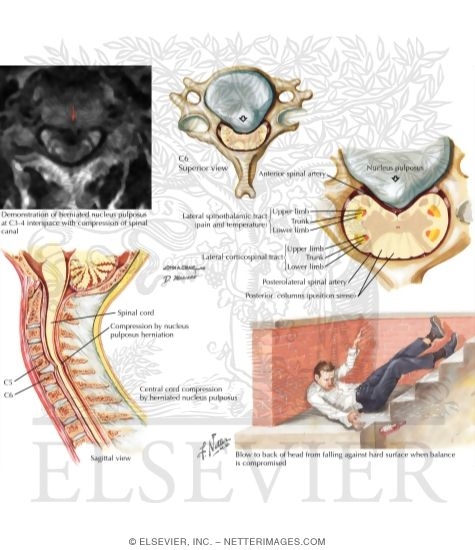Cervical Disc Herniation